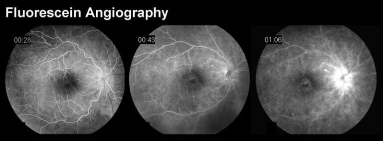 FA (Fluorescein Angiography) - Inland Valley Retina